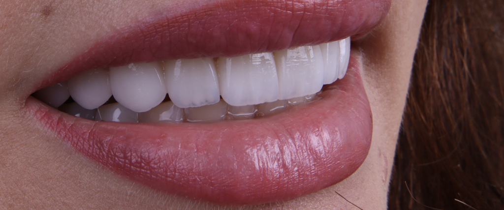 Emax Laminate Veneers – OZClinic Dental Centre